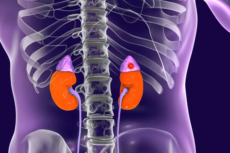 Feocromocitoma: Entenda o Tumor das Glândulas Suprarrenais